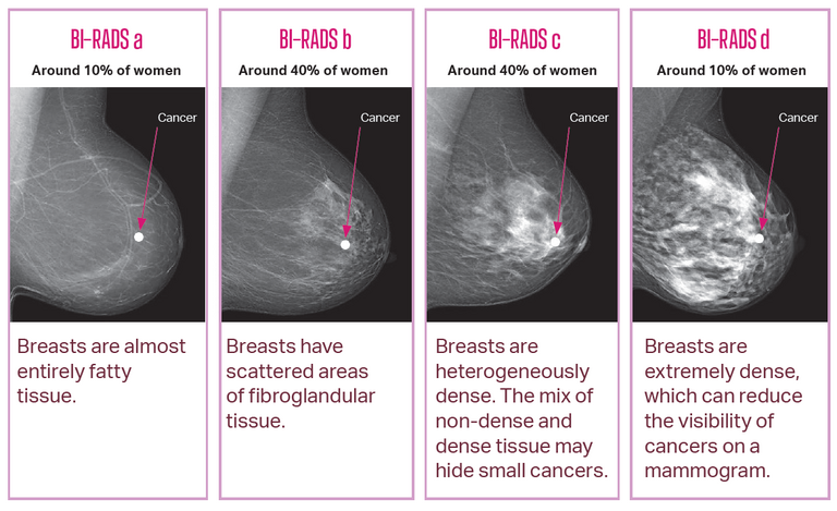 BreastScreen SA • Breast density BreastScreen SA • Breast density