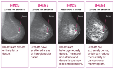 BreastScreen SA • Breast density