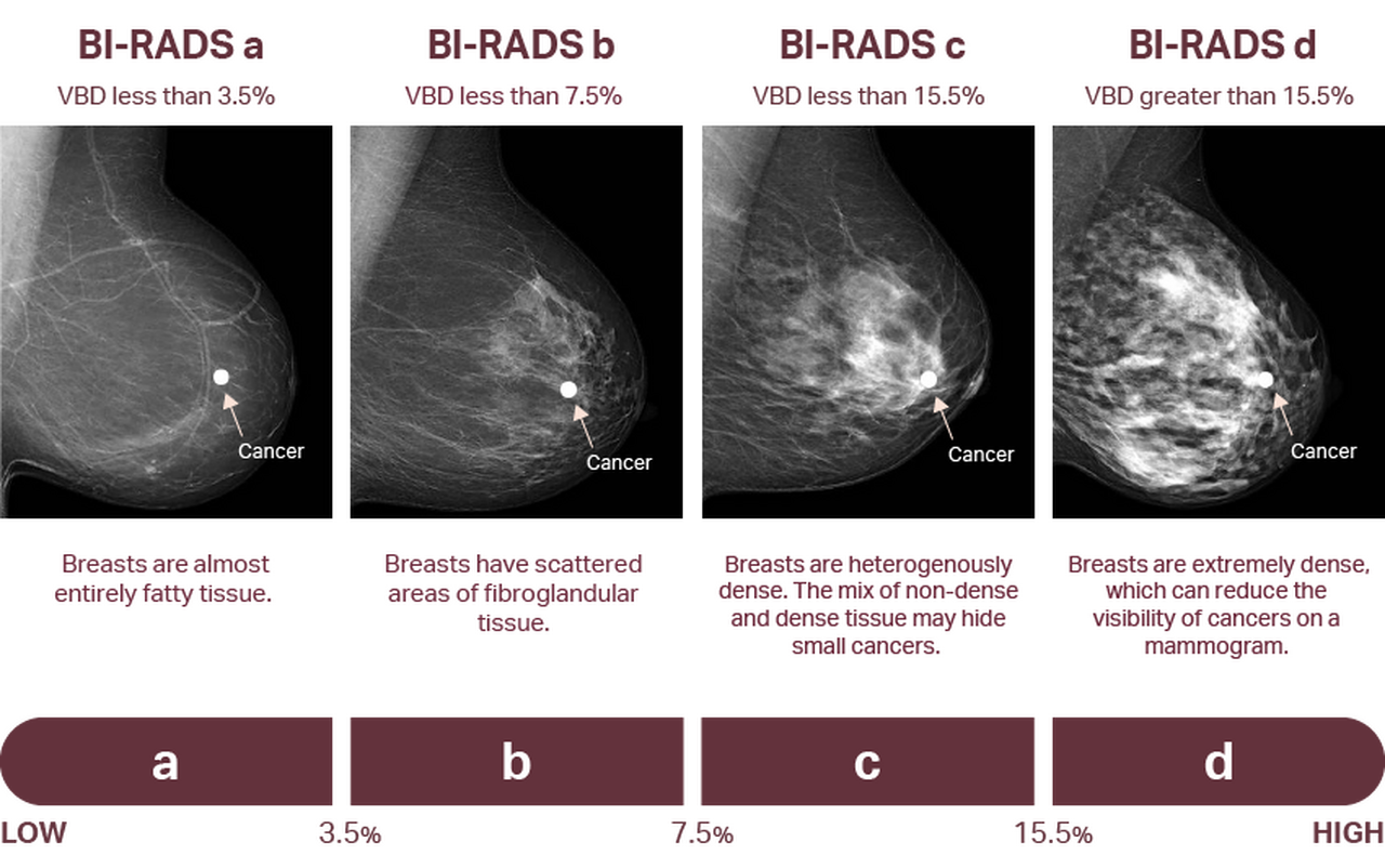 BreastScreen SA • Breast density