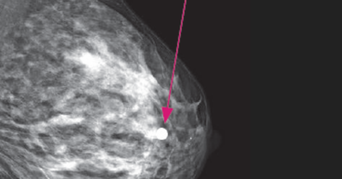 Breastscreen Sa Breast Density Research